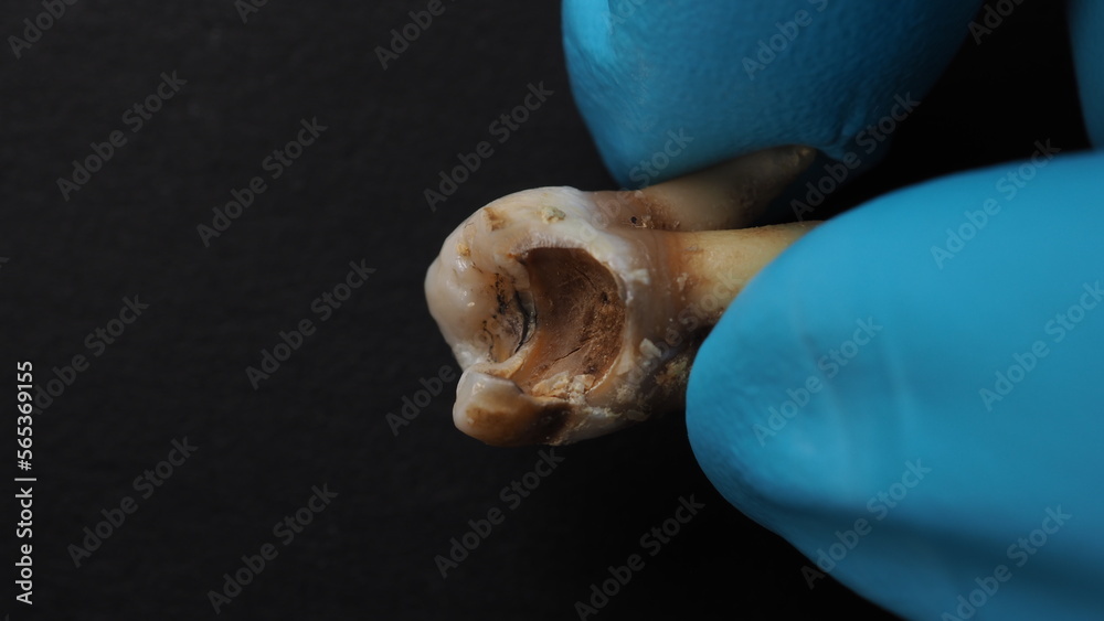 Tooth decay and dentist hand with glove and black background. Macro ...