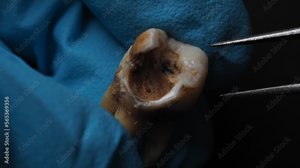 Tooth decay and dentist hand with glove and black background. Macro ...