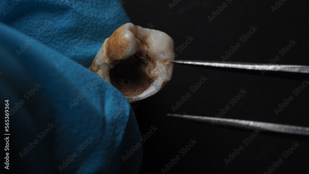 Tooth decay and dentist hand with glove and black background. Macro ...
