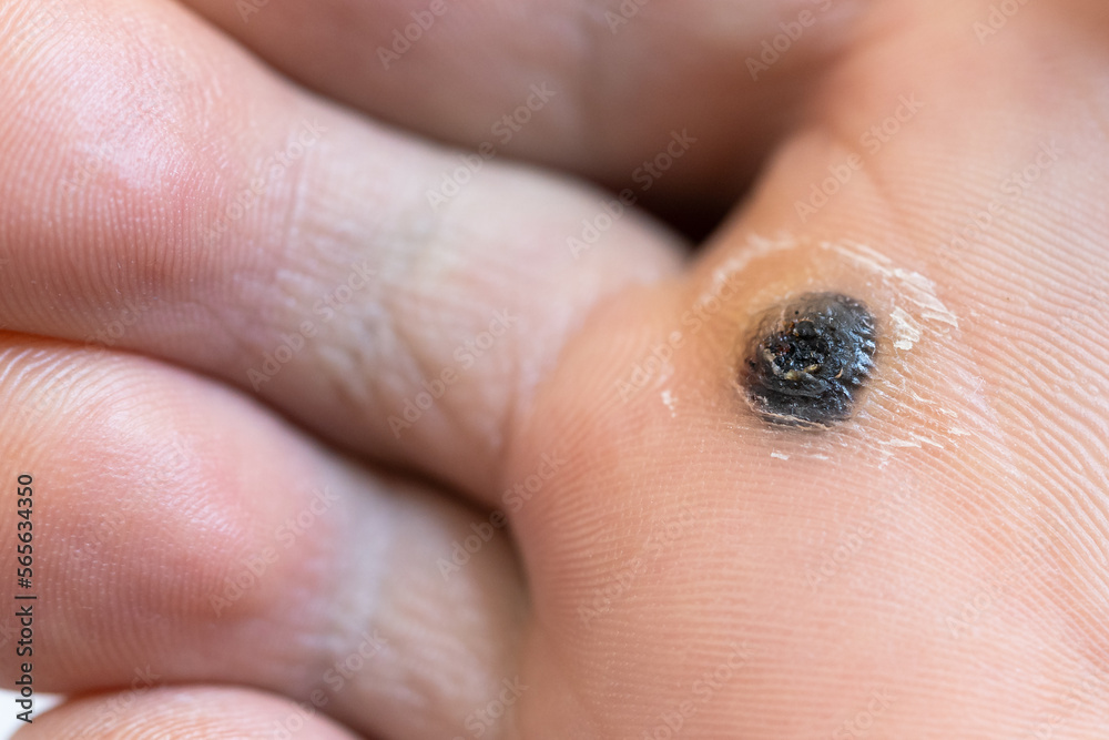 Closeup of dead skin around wart plantar after cauterizing it with ...