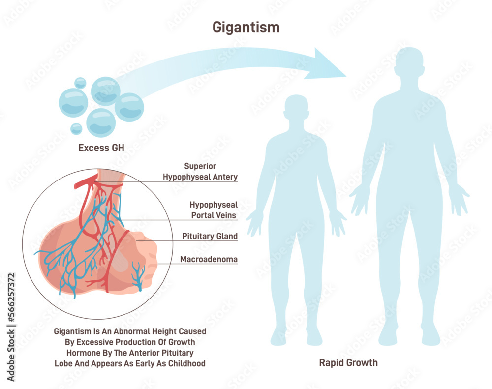 Gigantism. Syndrome characterized by excessive secretion of growth ...