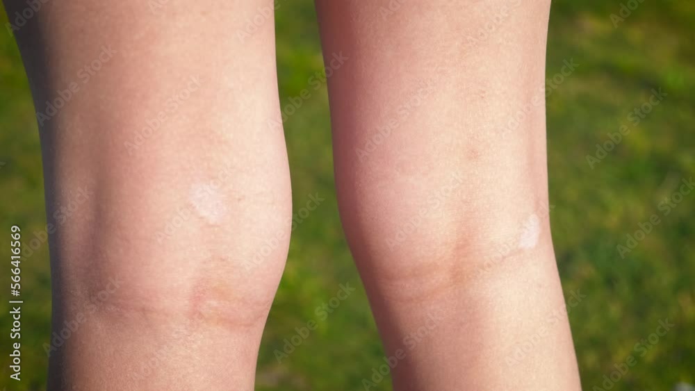 White spots on the skin of a child. Vitiligo on children's legs. vídeo ...