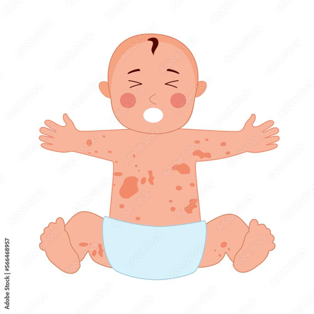 Baby in diaper with rash on body skin in flat design on white ...