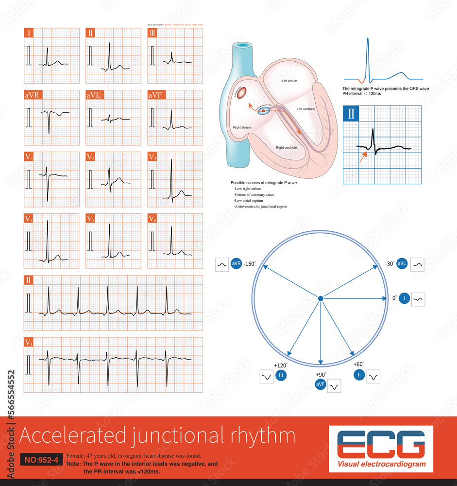 The retrograde P wave of the inferior leads can come from the lower ...
