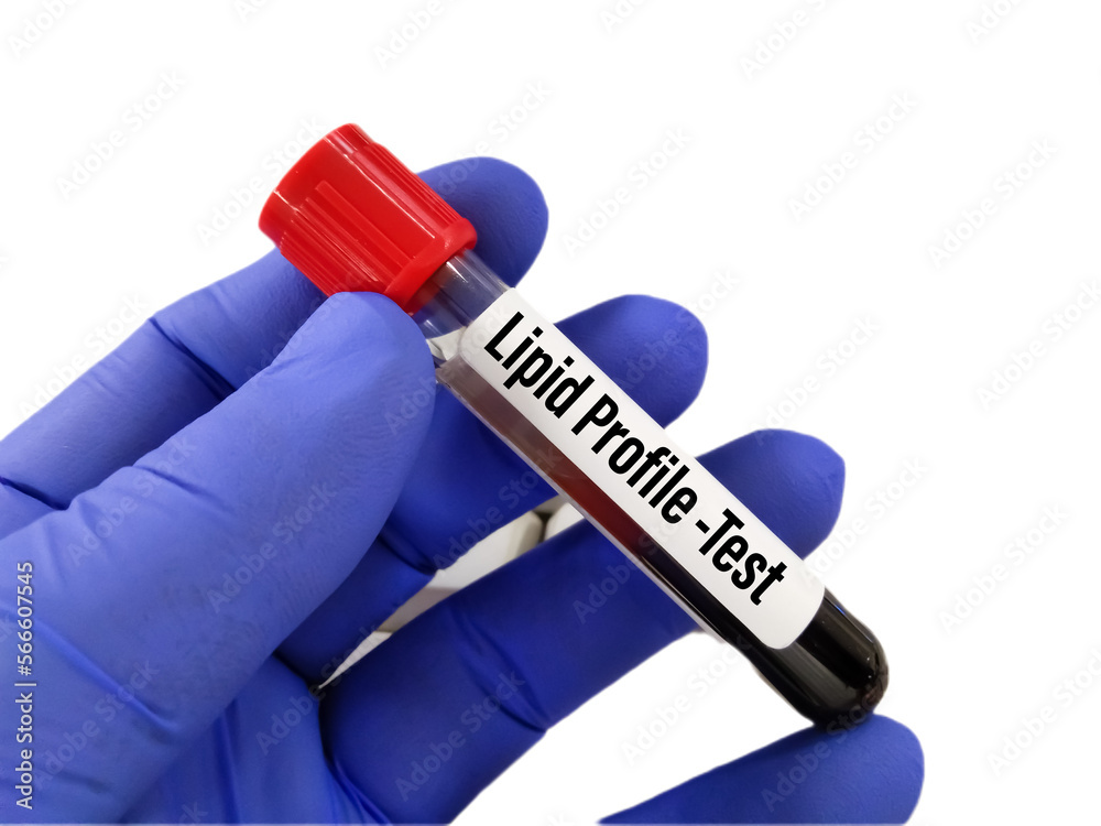 Blood sample for Lipid profile, Triglyceride, HDL and LDL test. Copy ...