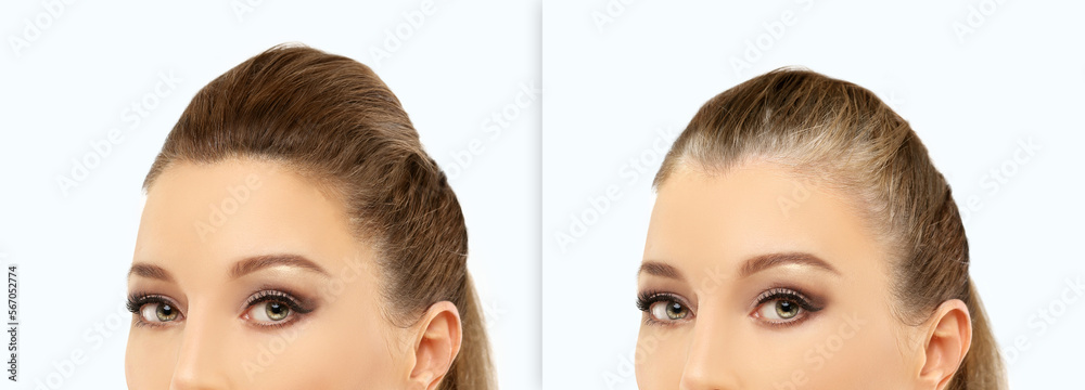 Alopecia Areata,female pattern baldness,Treatment for hair loss,Hair ...