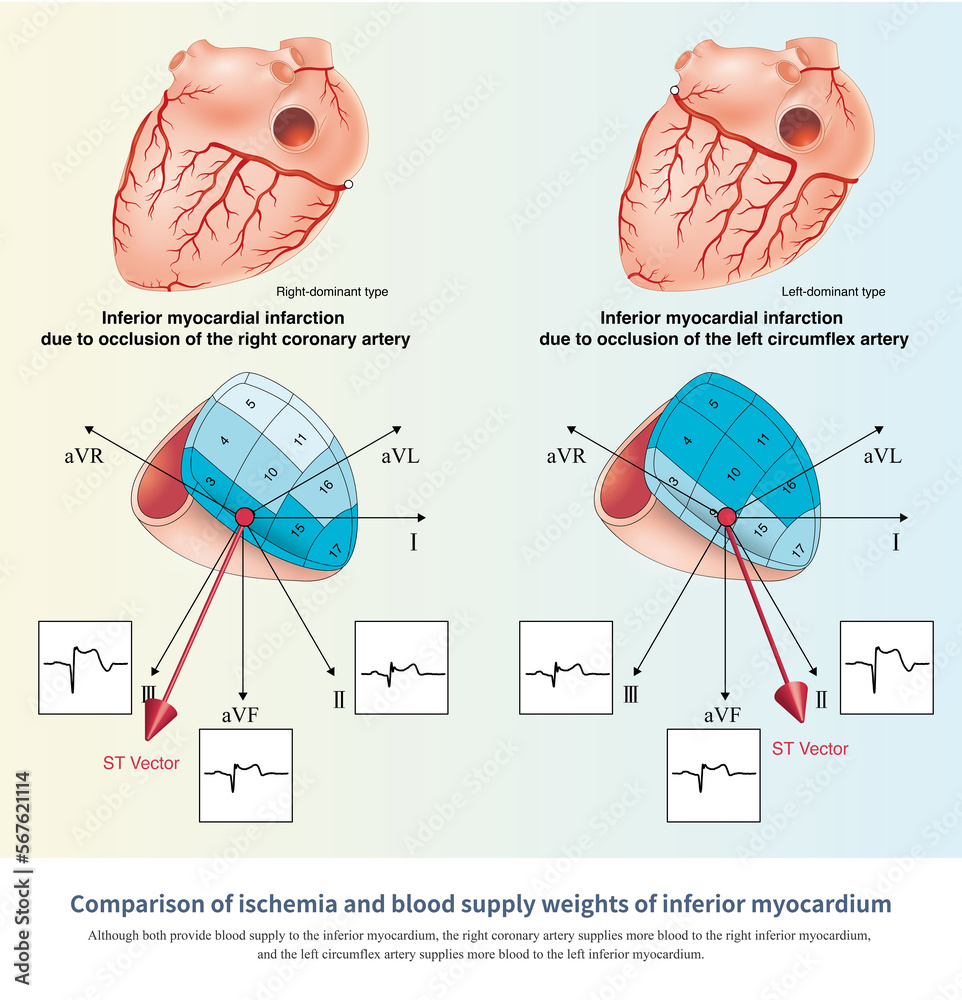 When acute inferior myocardial infarction occurs, the amplitude of ST ...