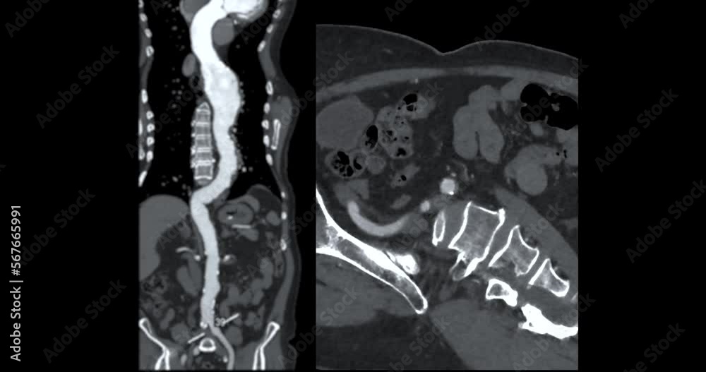 3d rendering, aaa, abdominal aorta, anatomy, aneurysm, angiogram ...