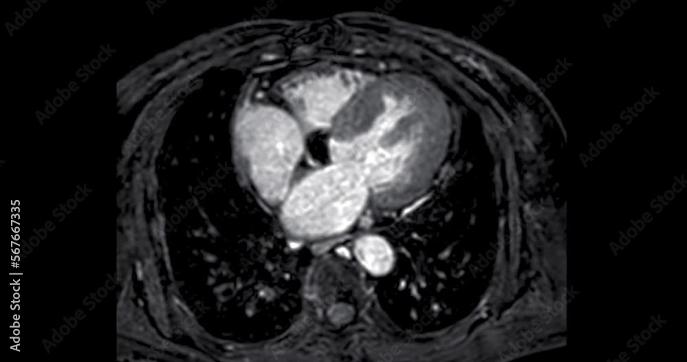 MRI heart or Cardiac MRI ( magnetic resonance imaging ) of heart in ...