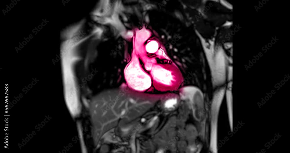 MRI heart or Cardiac MRI ( magnetic resonance imaging ) of heart in ...