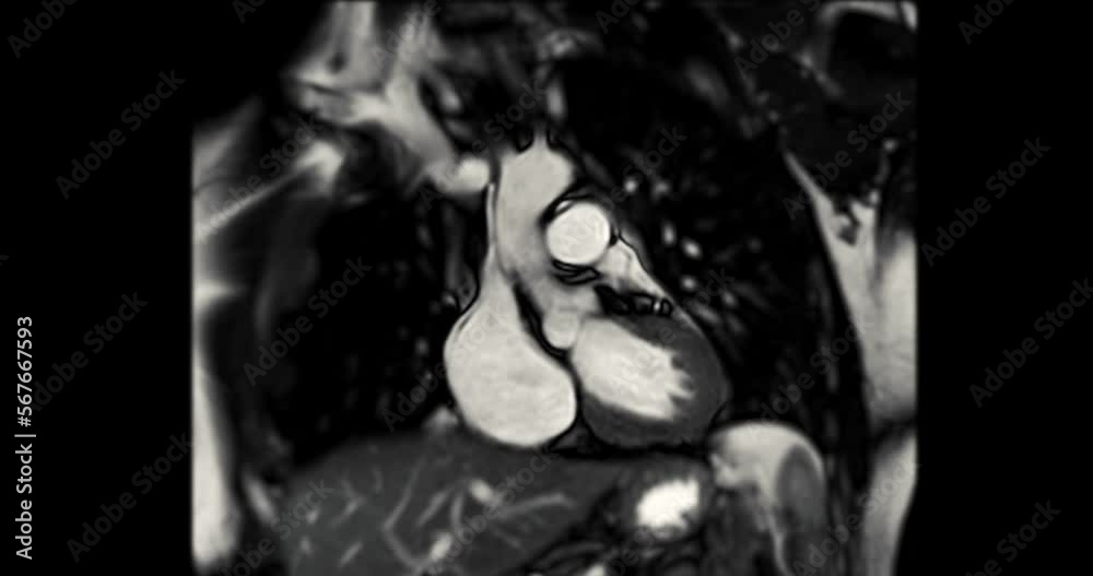 MRI heart or Cardiac MRI ( magnetic resonance imaging ) of heart in ...