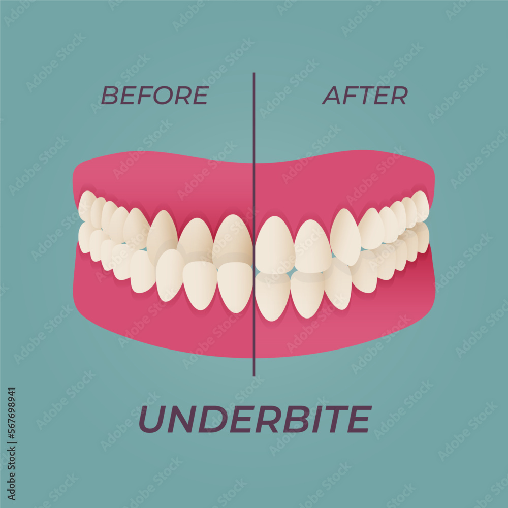 Human teeth malocclusion set with realistic images of mouth jaws with ...