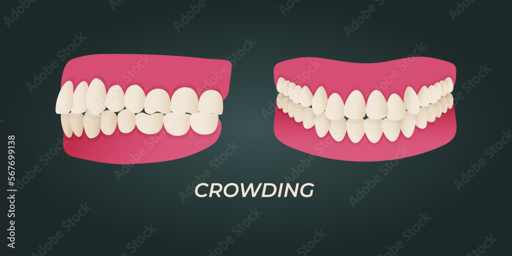Human teeth malocclusion set with realistic images of mouth jaws with ...