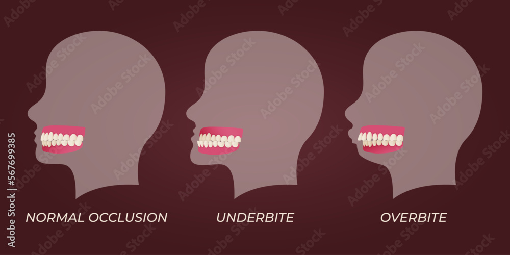 Human teeth malocclusion set with realistic images of mouth jaws with ...