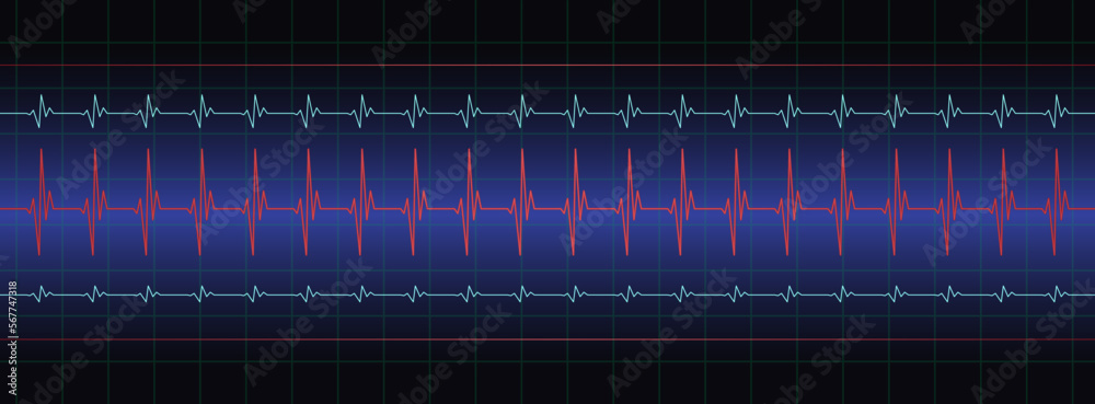 3d editable stroke ecg, ekg monitor with cardio diagnosis illustration ...