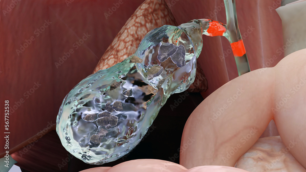 Stomach Acid Relux. Esophagus, gerd. Pain In The Digestive System ...