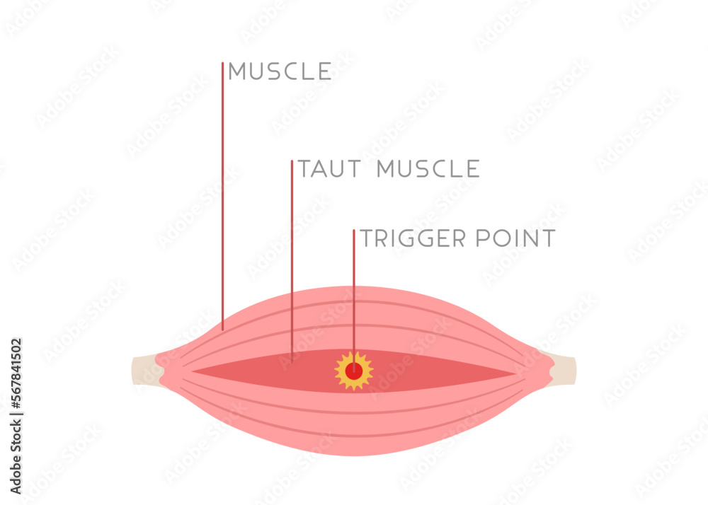 Illustration of tight muscle fibers with trigger point isolated on ...