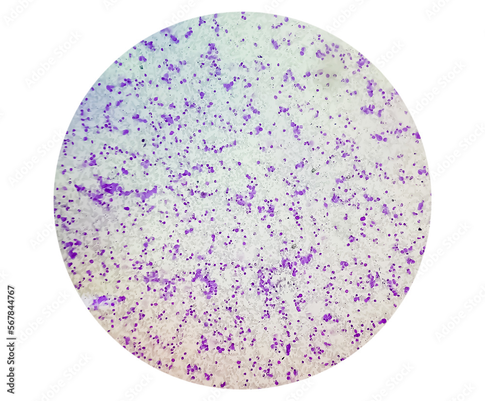 Essential thrombocytosis blood smear showing abnormal high volume of ...
