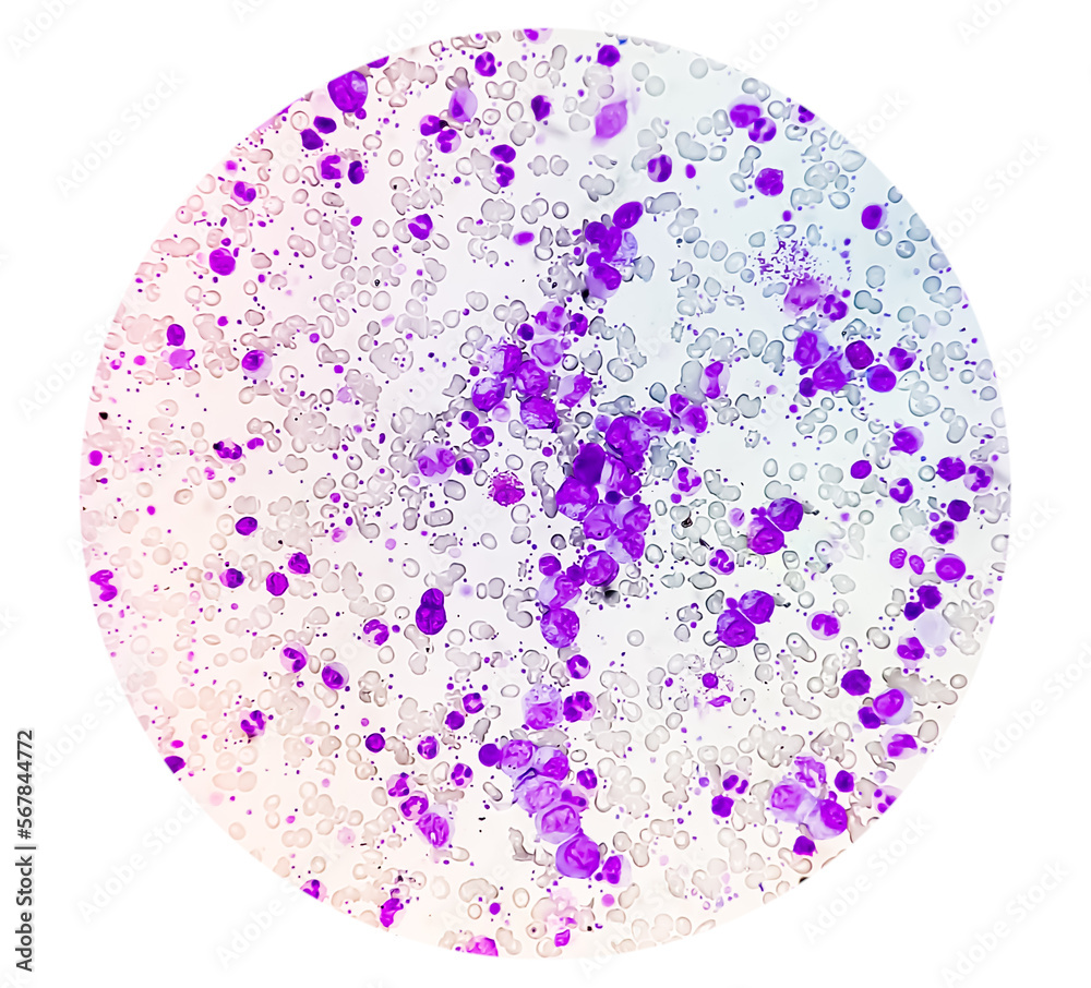 Essential thrombocytosis blood smear showing abnormal high volume of ...