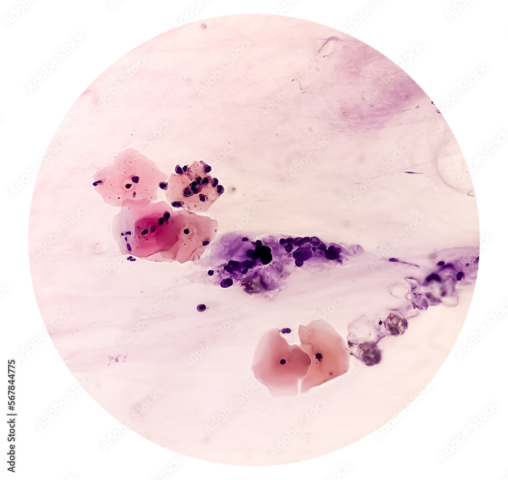 Paps smear under microscopy showing inflammatory smear with hpv related ...