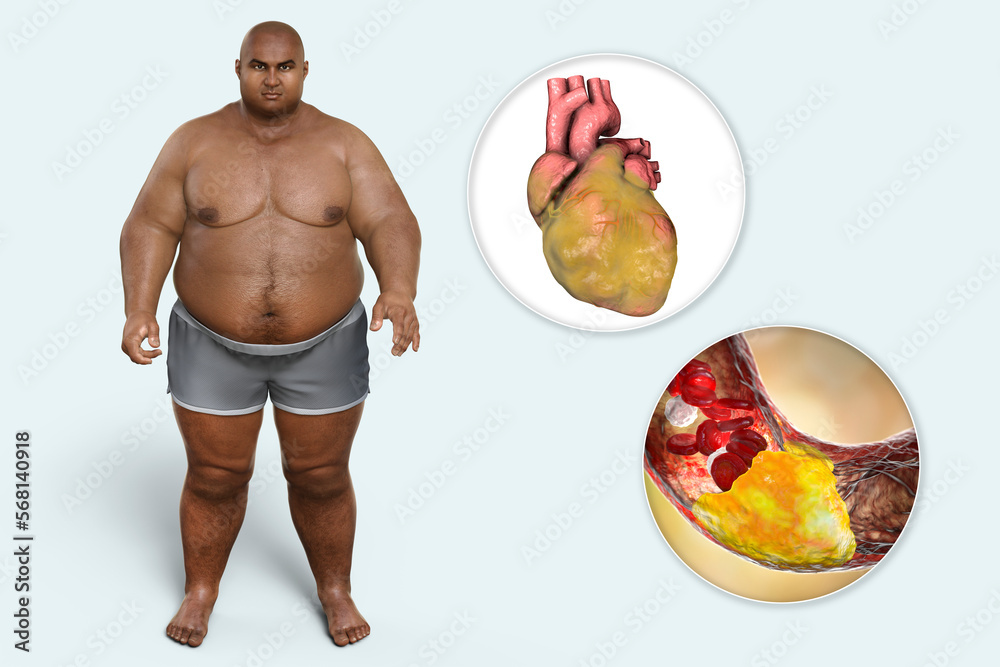 Obesity And Atherosclerosis 3D Illustration Atheromatous Plaque Obesity And Atherosclerosis 3D Illustration Atheromatous Plaque