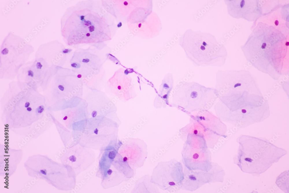 View in microscopic of Candidiasis, fungus infection (Yeast and ...