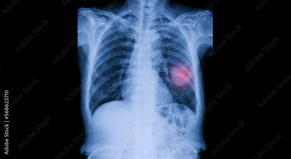 Radiograph on dark background in hospital.The x-ray used for diagnosis ...