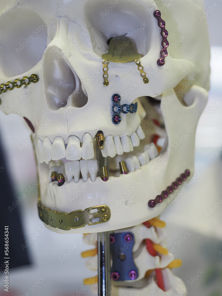 mock-up of a human skull with specimens plate for attaching cracks ...
