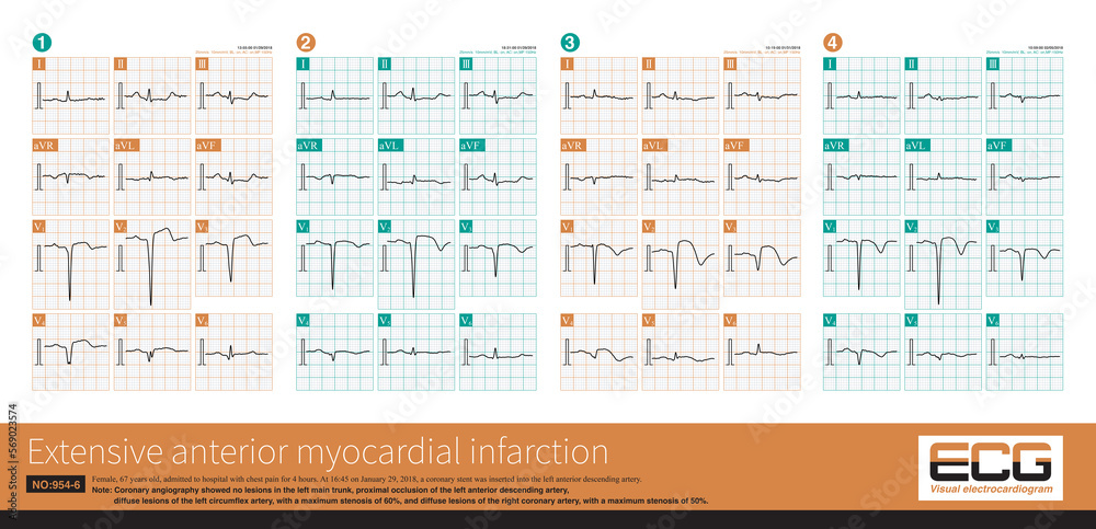 A 67-year-old patient with acute extensive anterior myocardial ...