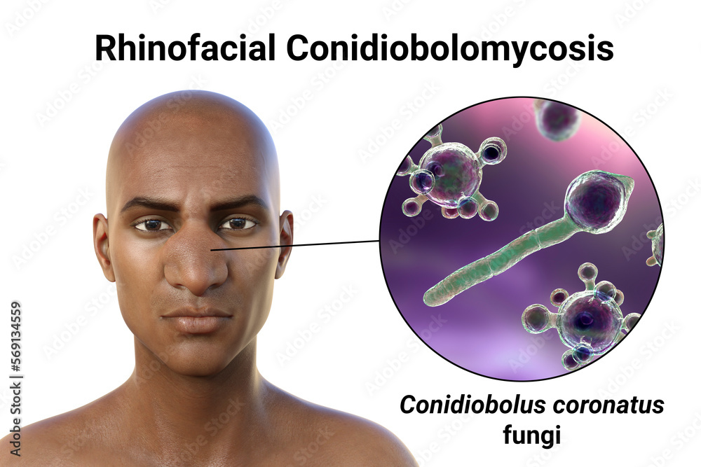 Rhinofacial conidiobolomycosis in a man and Conidiobolus coronatus ...