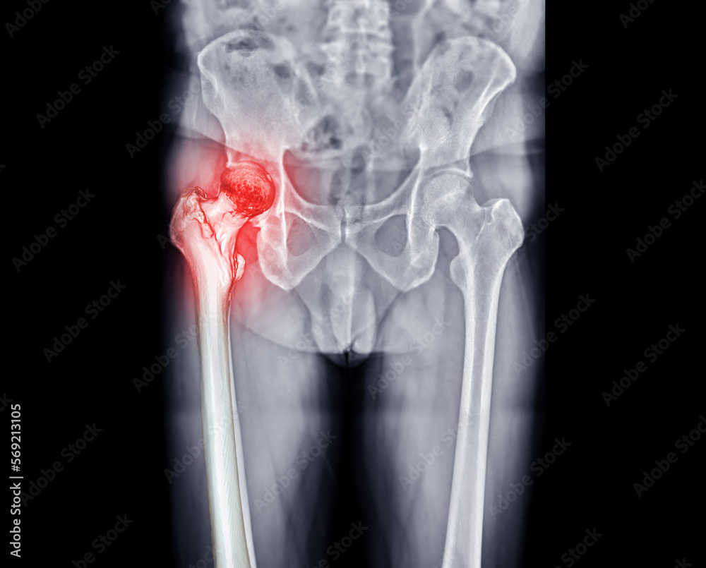 X Ray Both Hip Ap View Showing Right Hip Replacement Or Hip Prosthesis Made From Titanium