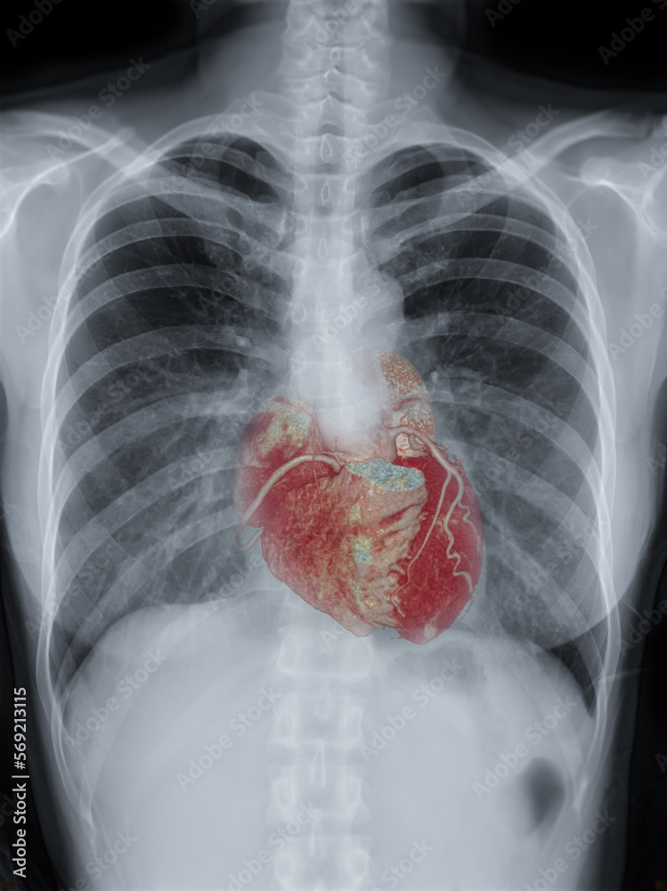 Fusion image of Chest X-ray image and 3D CTA Coronary artery for ...