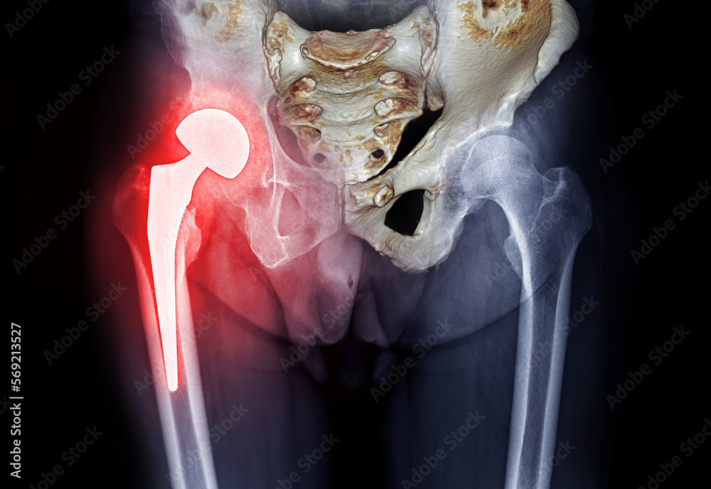 x-ray Both hip ap view showing Right hip replacement or hip prosthesis ...
