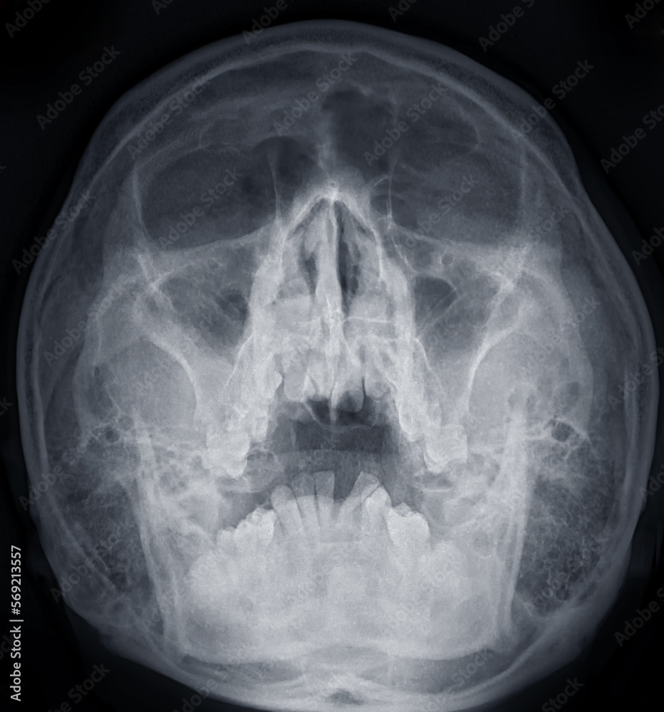 x-ray image of paranasal sinuses for diagnosis sinusitis. Stock Photo ...
