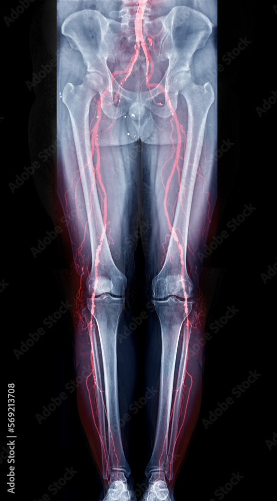 scanogram of lower extremity with Fusion CTA Femoral run off showing ...
