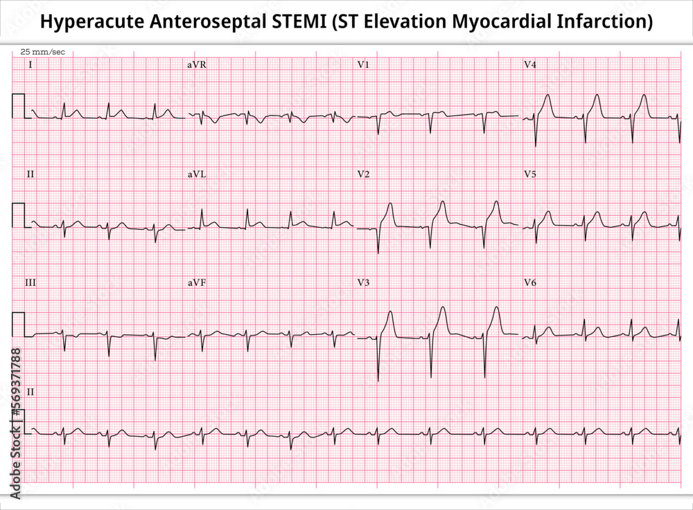 Ecg Of St Elevation Myocardial Infarction Stemi Vector Image Sexiz Pix