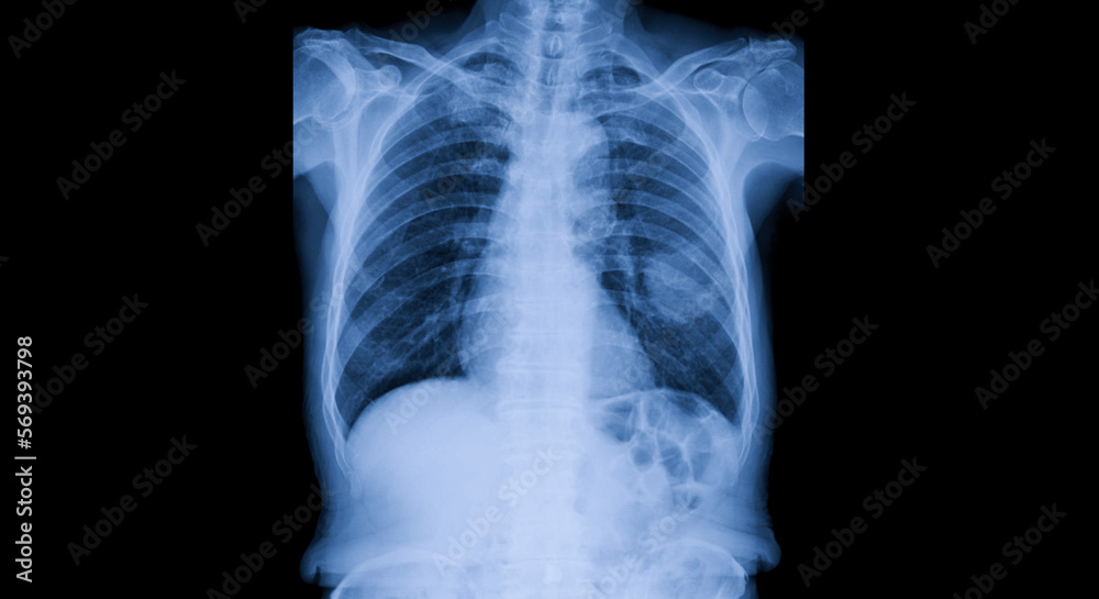 The radiograph on dark background in a hospital.X-ray is used for the ...