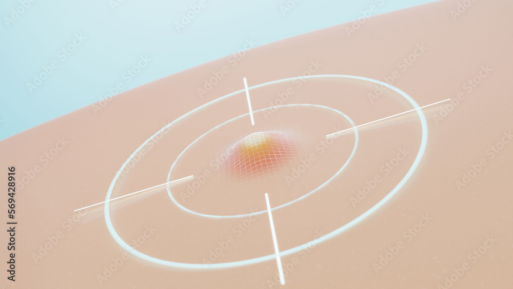 Acne on face skin with lock symbol for acne treatment concept. 3D ...