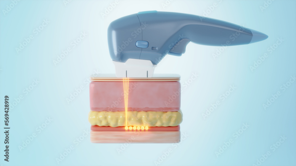 HIFU or Ulthera machine shot laser to SMAS skin. 3D rendering. Stock ...