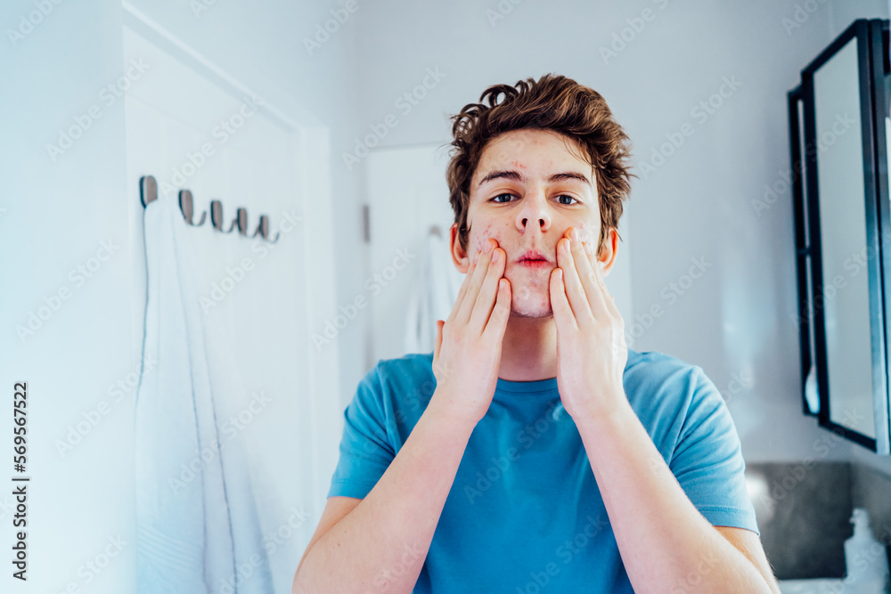 Concentrated caucasian teenage boy with acne problem take care his face ...