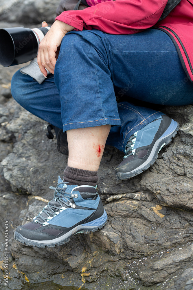 woman sit on rocks view legs shown bleeding injury at the calf Stock ...