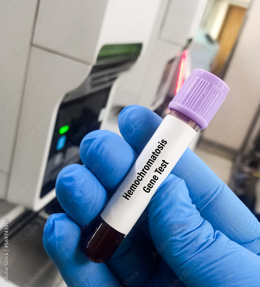 Blood sample for Hereditary Hemochromatosis gene mutation test, a ...