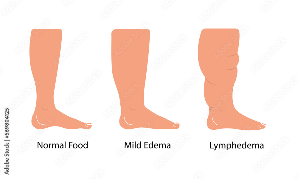 Lymphedema stages. Lymphatic system dysfunction disease. Swollen legs ...
