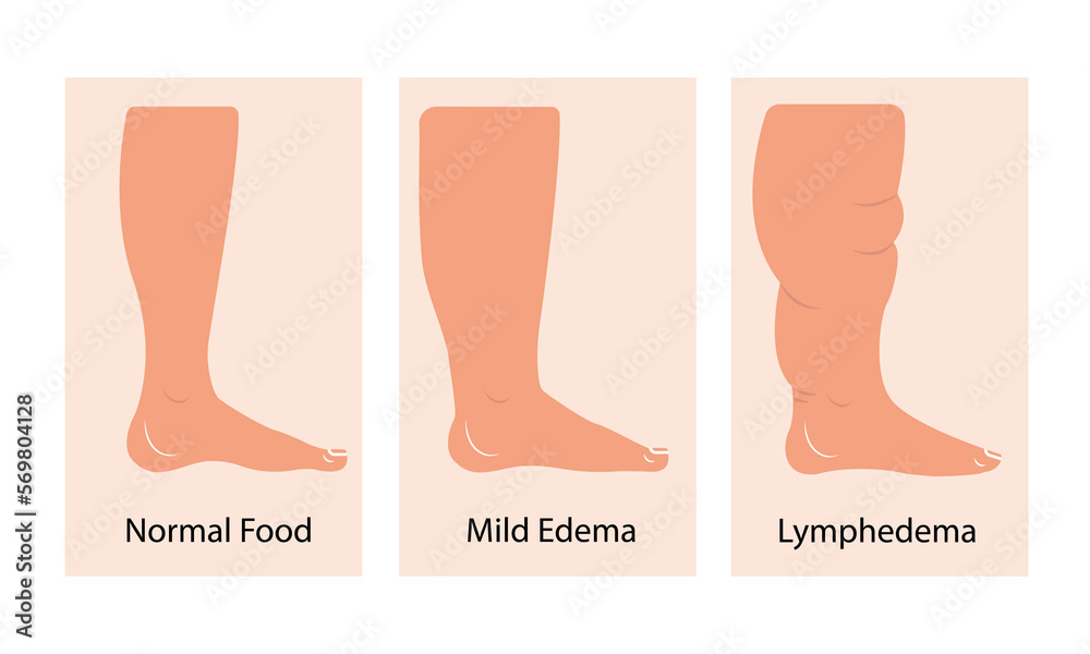 Lymphedema stages. Lymphatic system dysfunction disease. Swollen legs ...