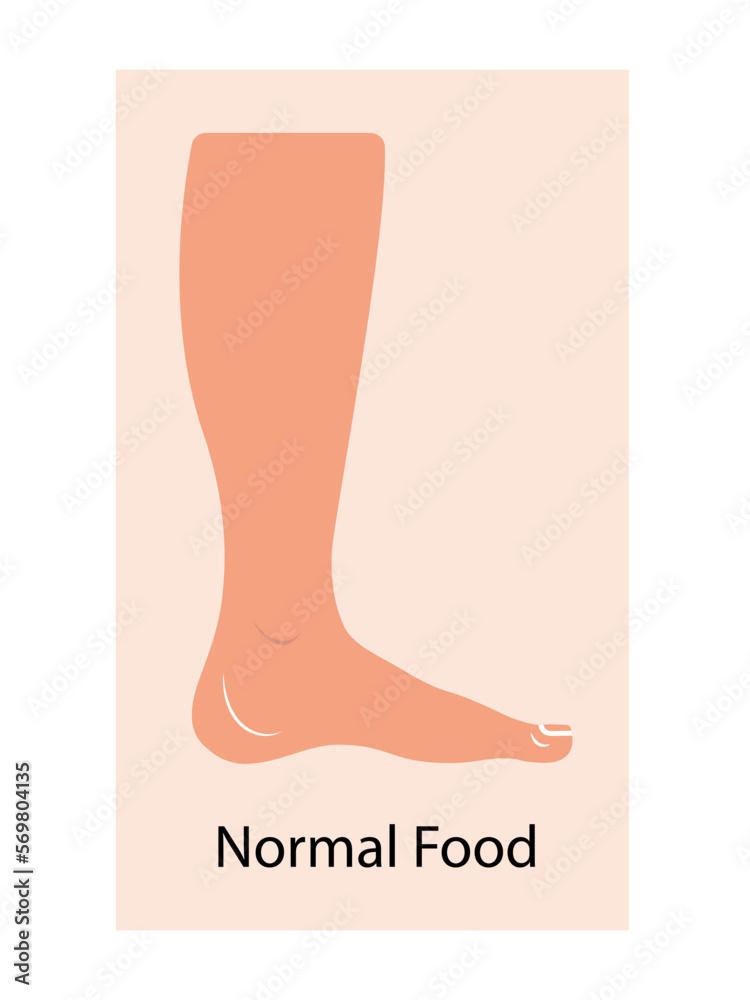 Lymphedema stages. Lymphatic system dysfunction disease. Swollen legs ... Lymphedema stages. Lymphatic system dysfunction disease. Swollen legs ...