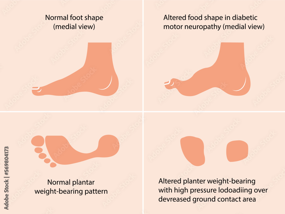 Altered shape of the foot caused by diabetic motor neuropathy. Created ...