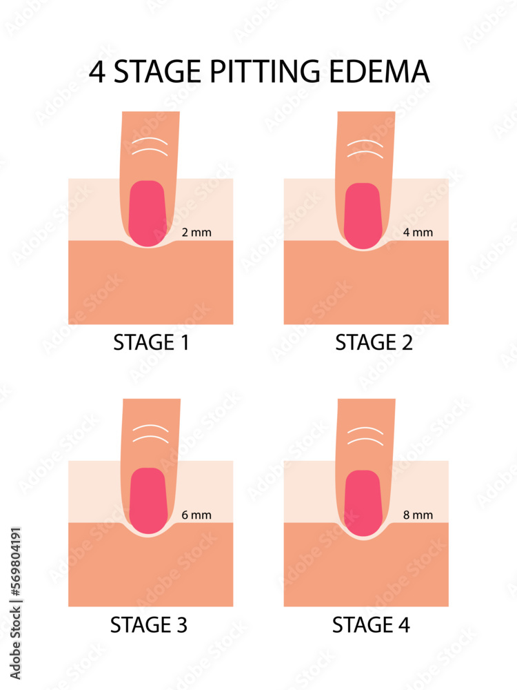 Meige’s syndrome Milroy Leg edema venous Deep vein cancer swelling ...