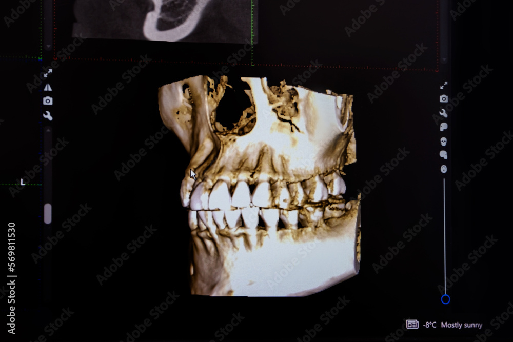 Close up photo panoramic x-ray of the jaw on a computer screen. The ...