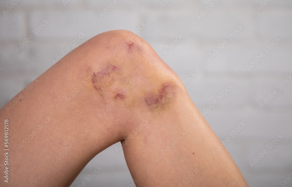 Close up of stain bruise wound on leg, contusion young woman, girl on ...