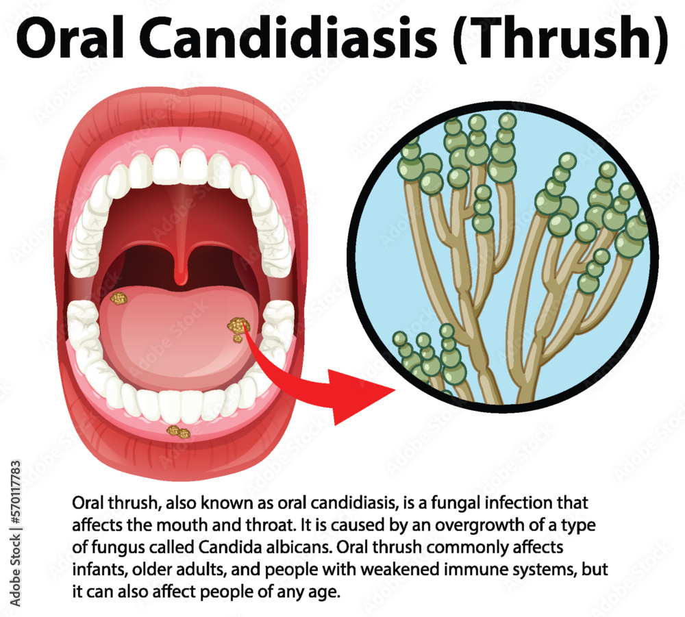 Oral Candidiasis Thrush Infographic With Explanation Stock Vector Adobe Stock